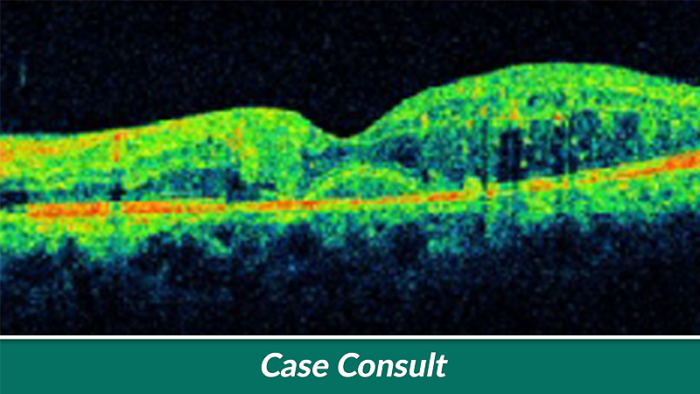 Patient With Combined PDR-DME - Eye Connect